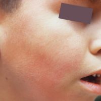 Disease Outbreak Control Division | Parvovirus B19 (Fifth Disease)