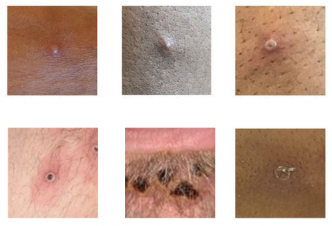 Mpox (Monkeypox) | Disease Outbreak Control Division